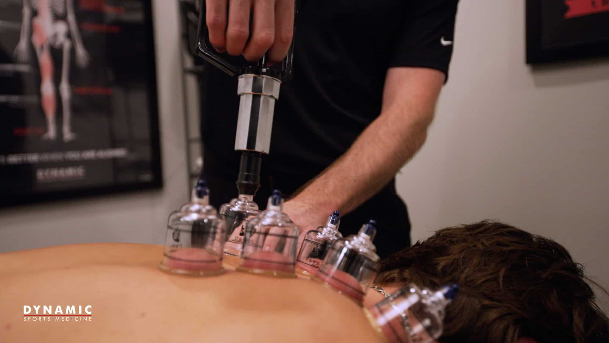Cupping Therapy in Bee Cave | Dynamic Sports Medicine